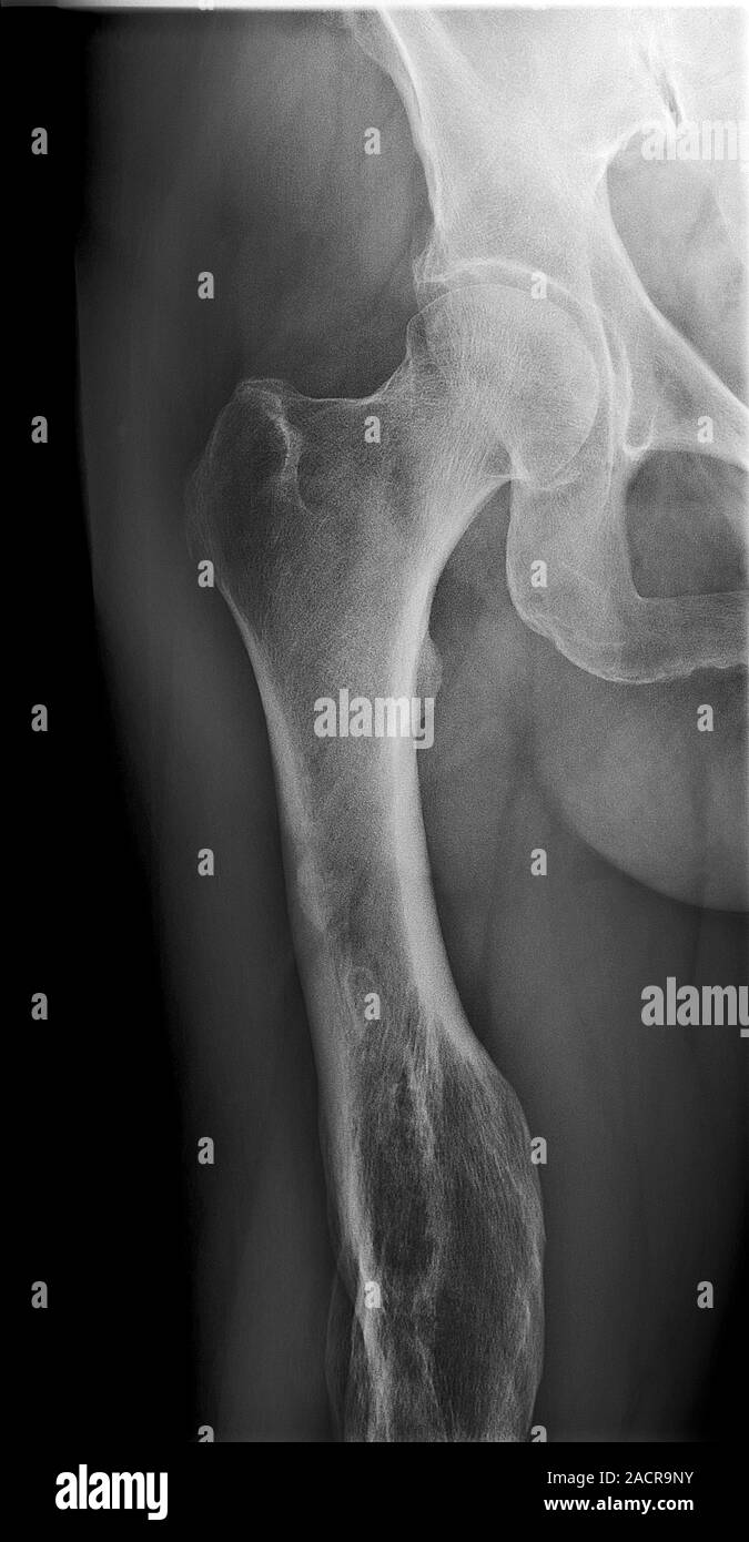 Malunited fracture. X-ray of the leg of a 64 year old female patient ...
