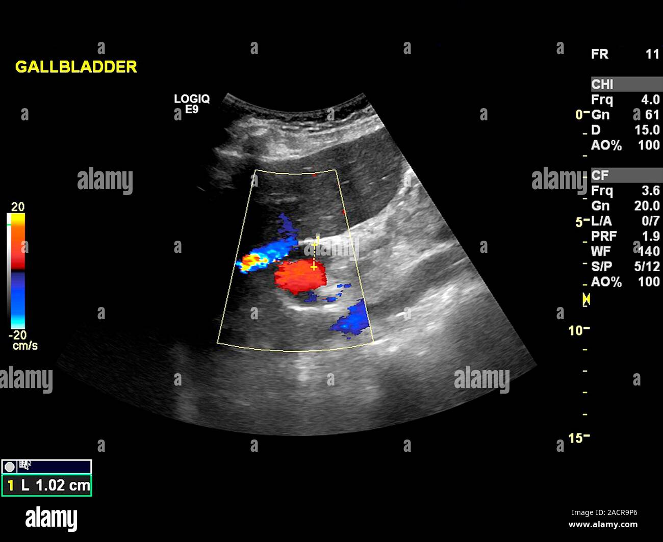 Gallstone. Doppler ultrasound scan of the gallbladder of a 81 year old ...