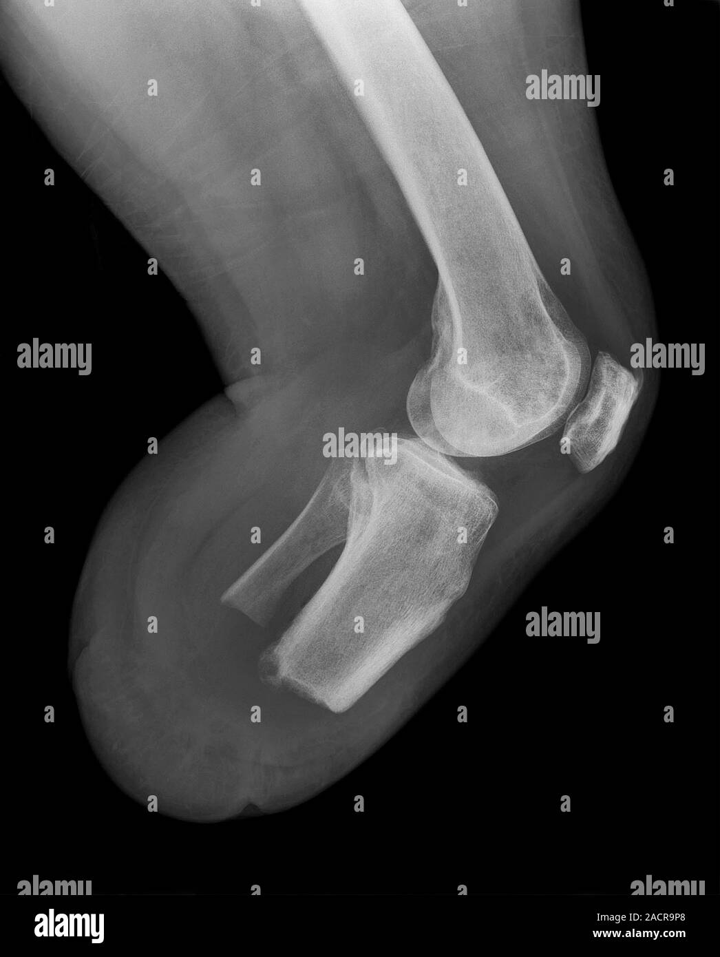 Amputated lower leg, X-ray. The leg has been amputated below the knee ...