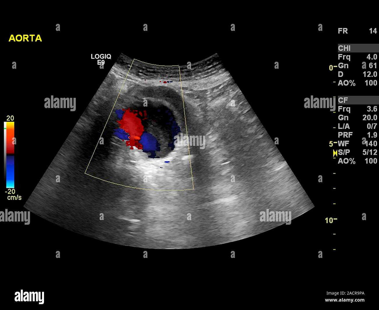Abdominal aortic aneurysm. Doppler ultrasound scan of the abdomen of a ...