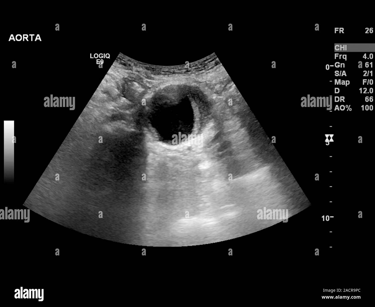 Abdominal aortic aneurysm. Ultrasound scan of the abdomen of a 83 year ...
