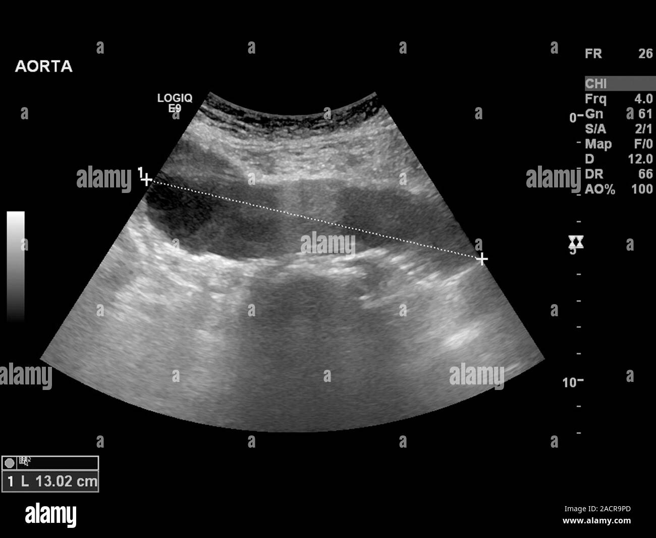 Abdominal aortic aneurysm. Ultrasound scan of the abdomen of a 83 year ...