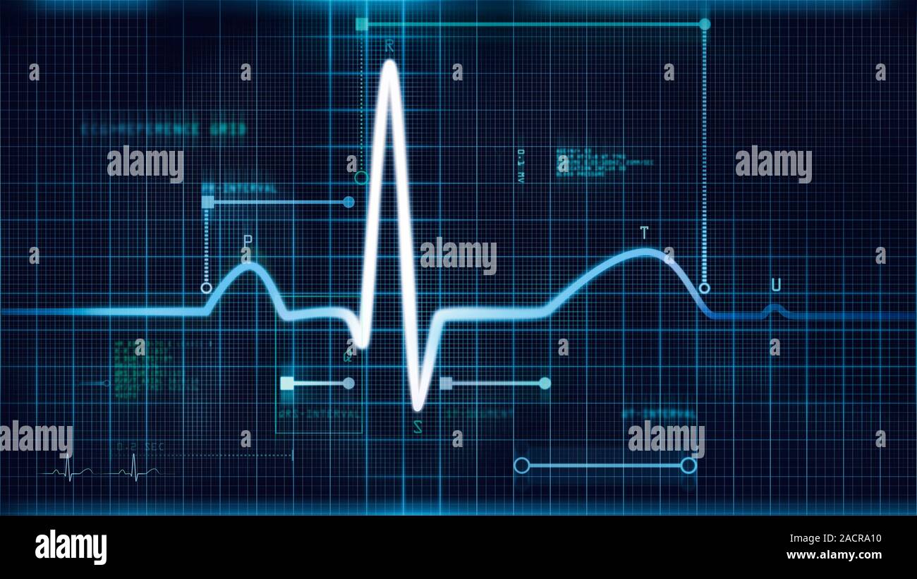 Electrocardiogram (ECG) trace. An ECG measures the electrical activity ...