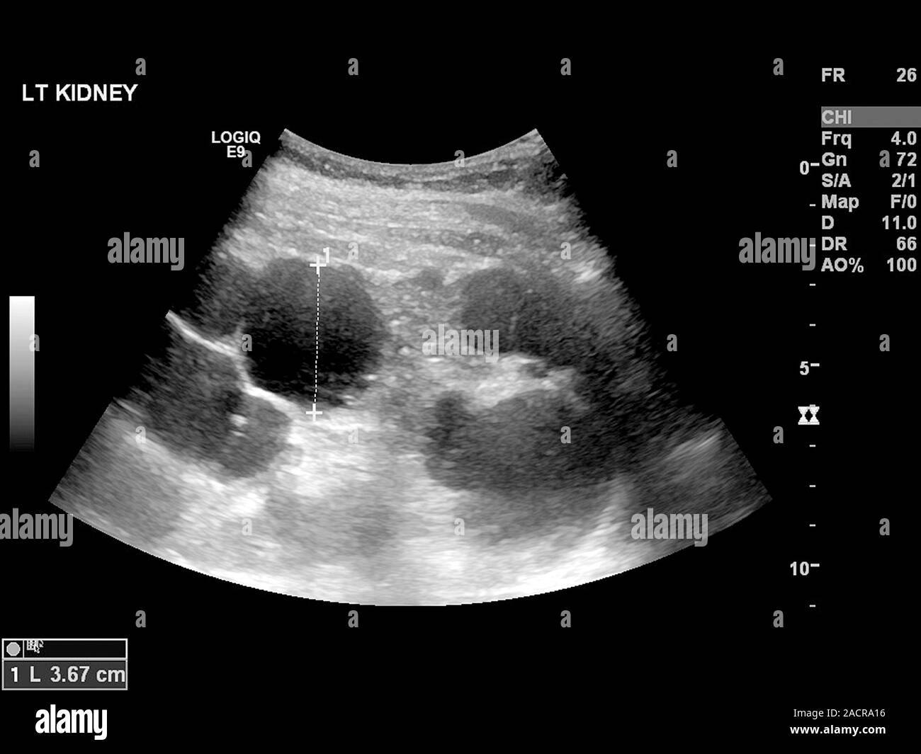 Polycystic kidney. Ultrasound scan of the kidney of a 42 year old ...