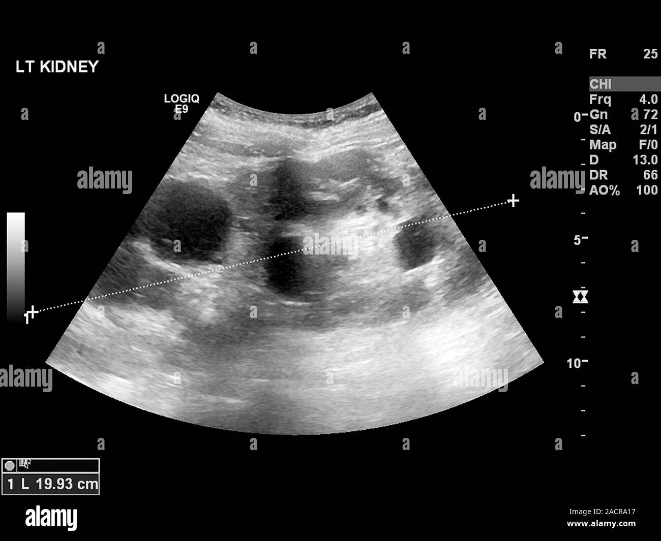 Polycystic kidney. Ultrasound scan of the kidney of a 42 year old ...