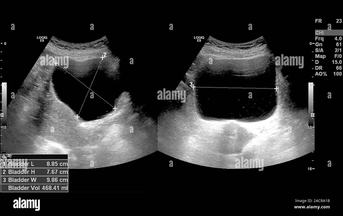 Polycystic kidneys. Ultrasound scan of the kidneys of a 42 year old ...