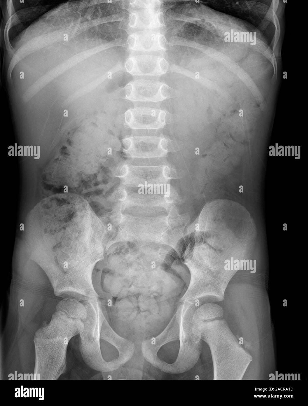 Swallowed marble. X-ray of the abdomen of a 4 year old male patient ...