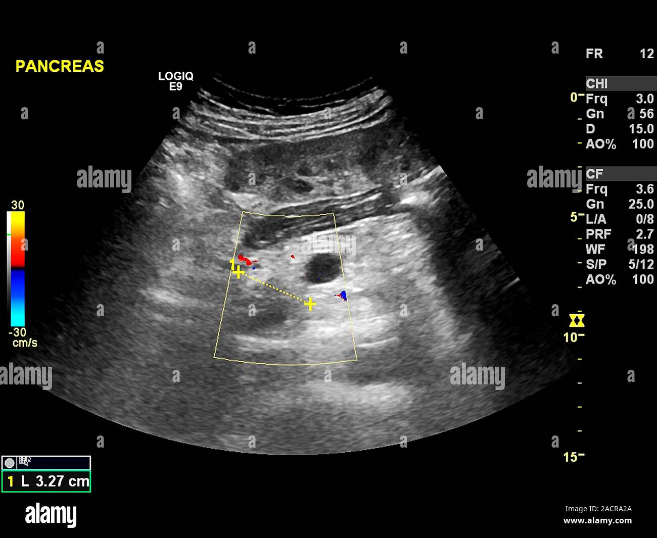 Secondary pancreatic cancer. Ultrasound scan of a 63 year old male ...