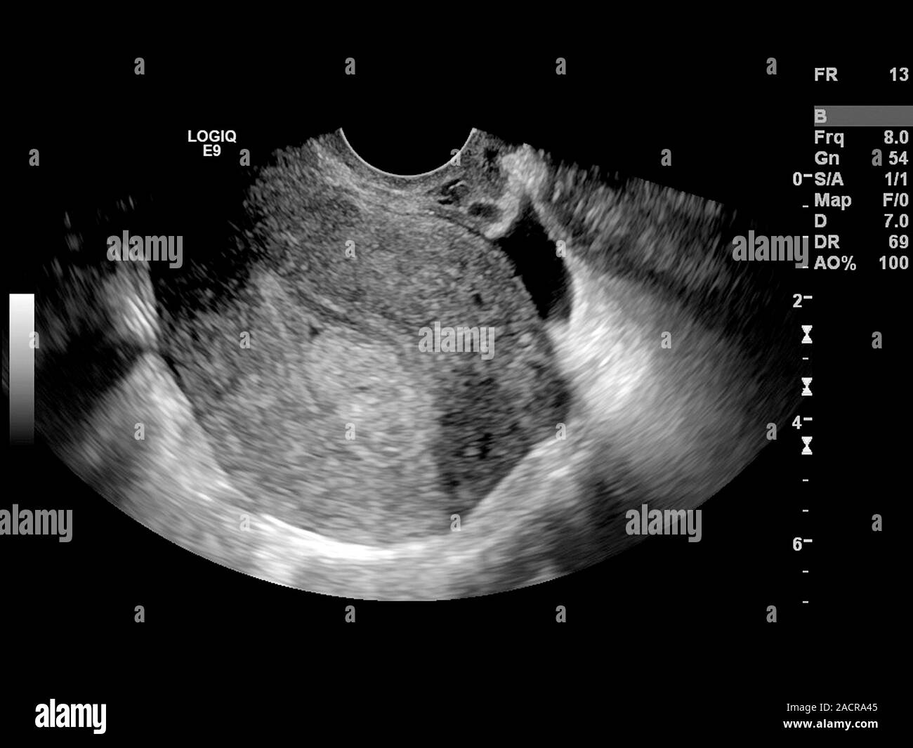 Endometrial Polyp Ultrasound Scan Of The Uterus Womb Of A 42 Year Old Female Patient With A