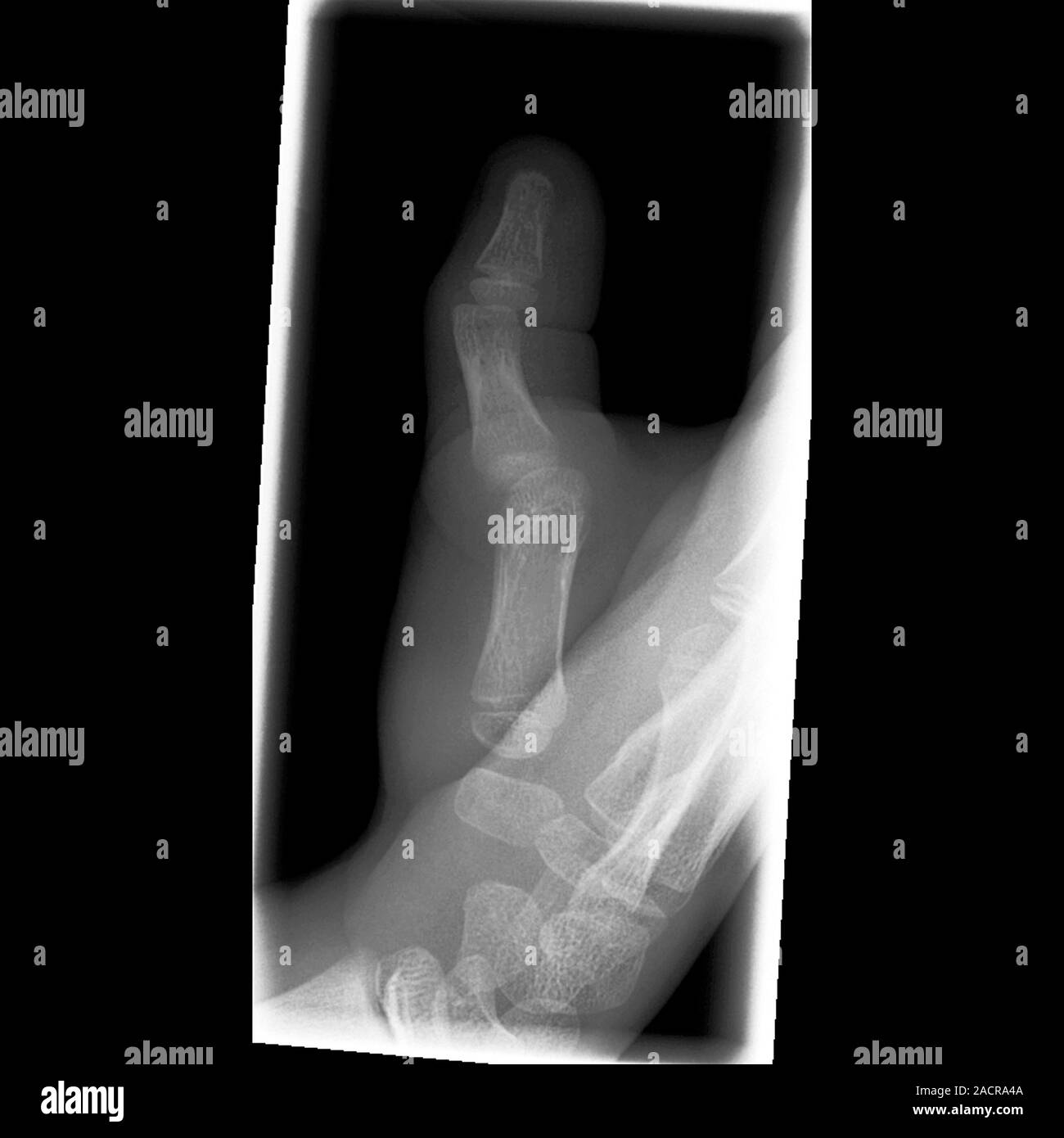 Dislocated thumb. X-ray of the right hand of a 10 year old male patient ...
