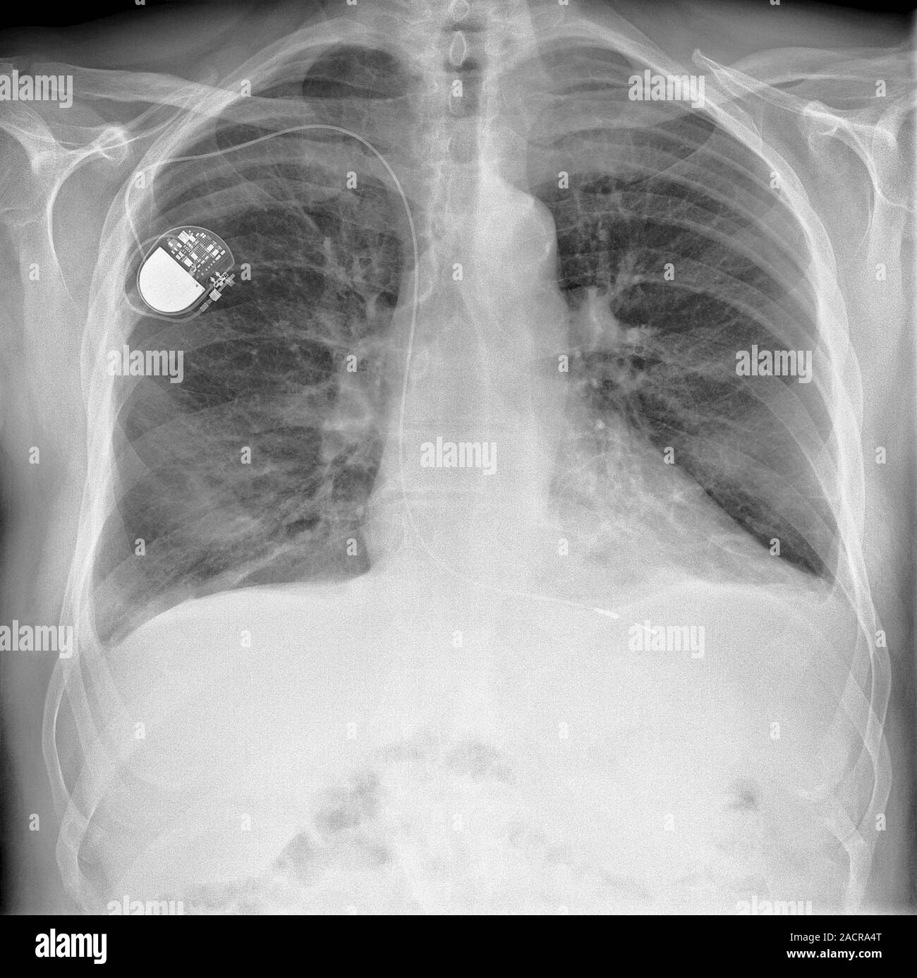 Pacemaker. X-ray of the chest of a patient that has a pacemaker (upper ...