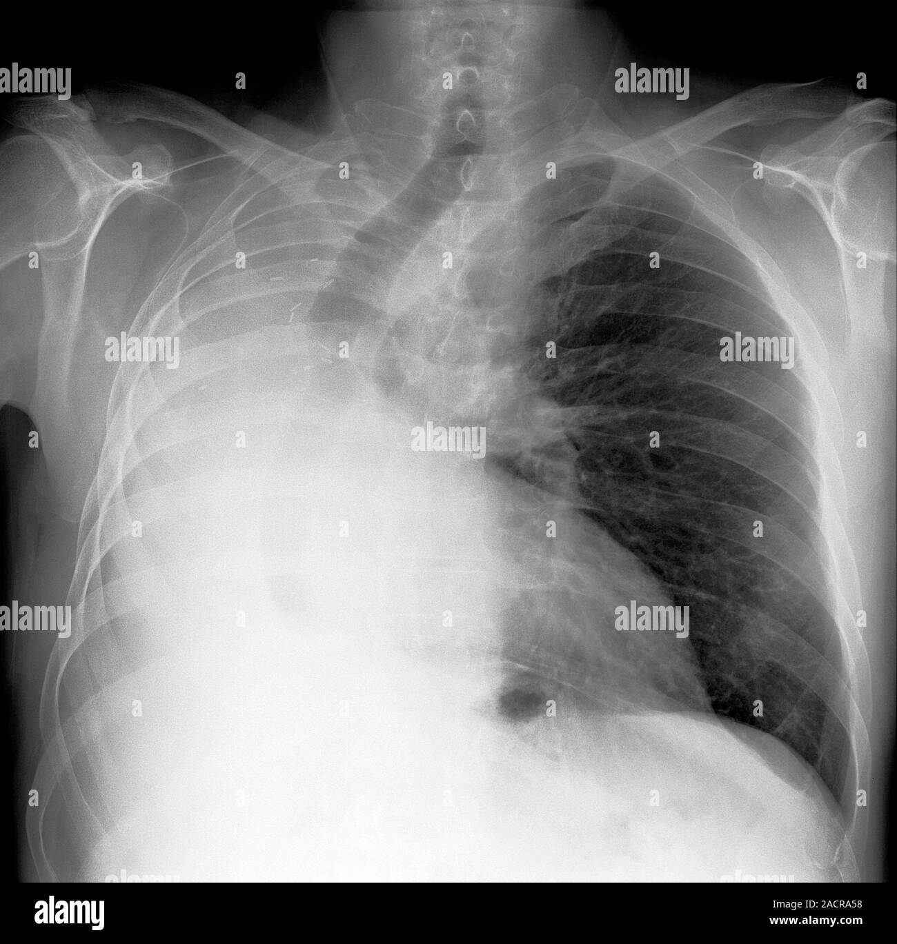 Removed lung. X-ray of the chest of a patient that has had their right ...