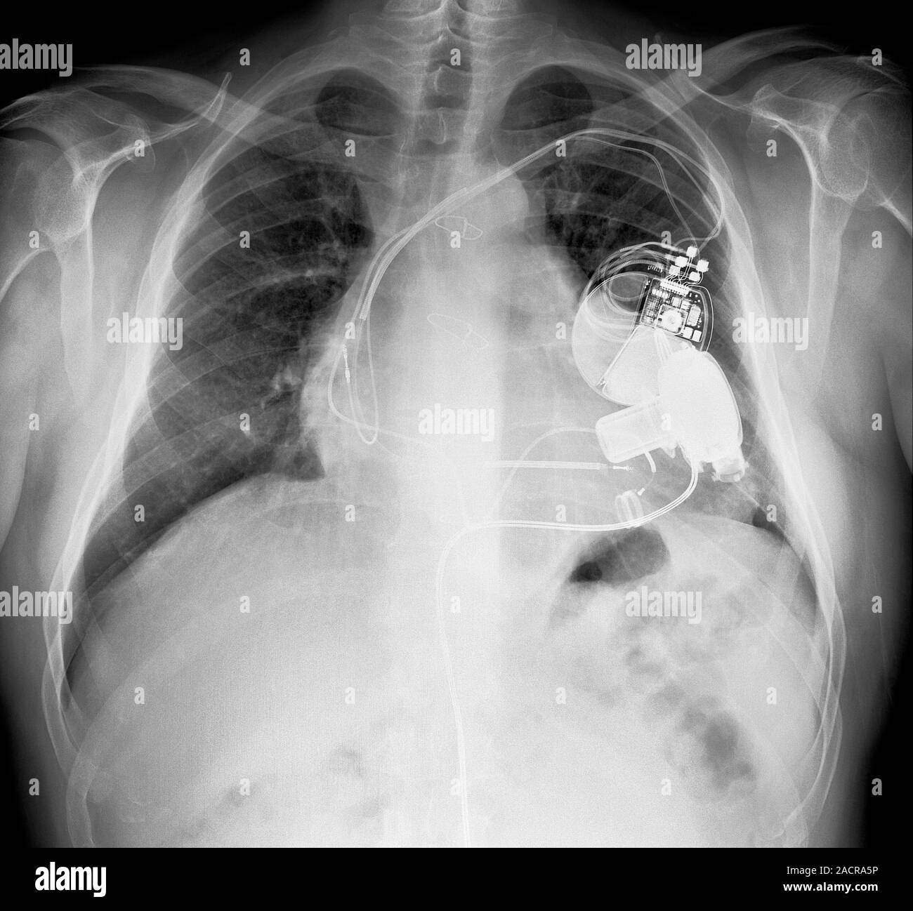Pacemaker and heart pump. X-ray of the chest of a patient who is ...