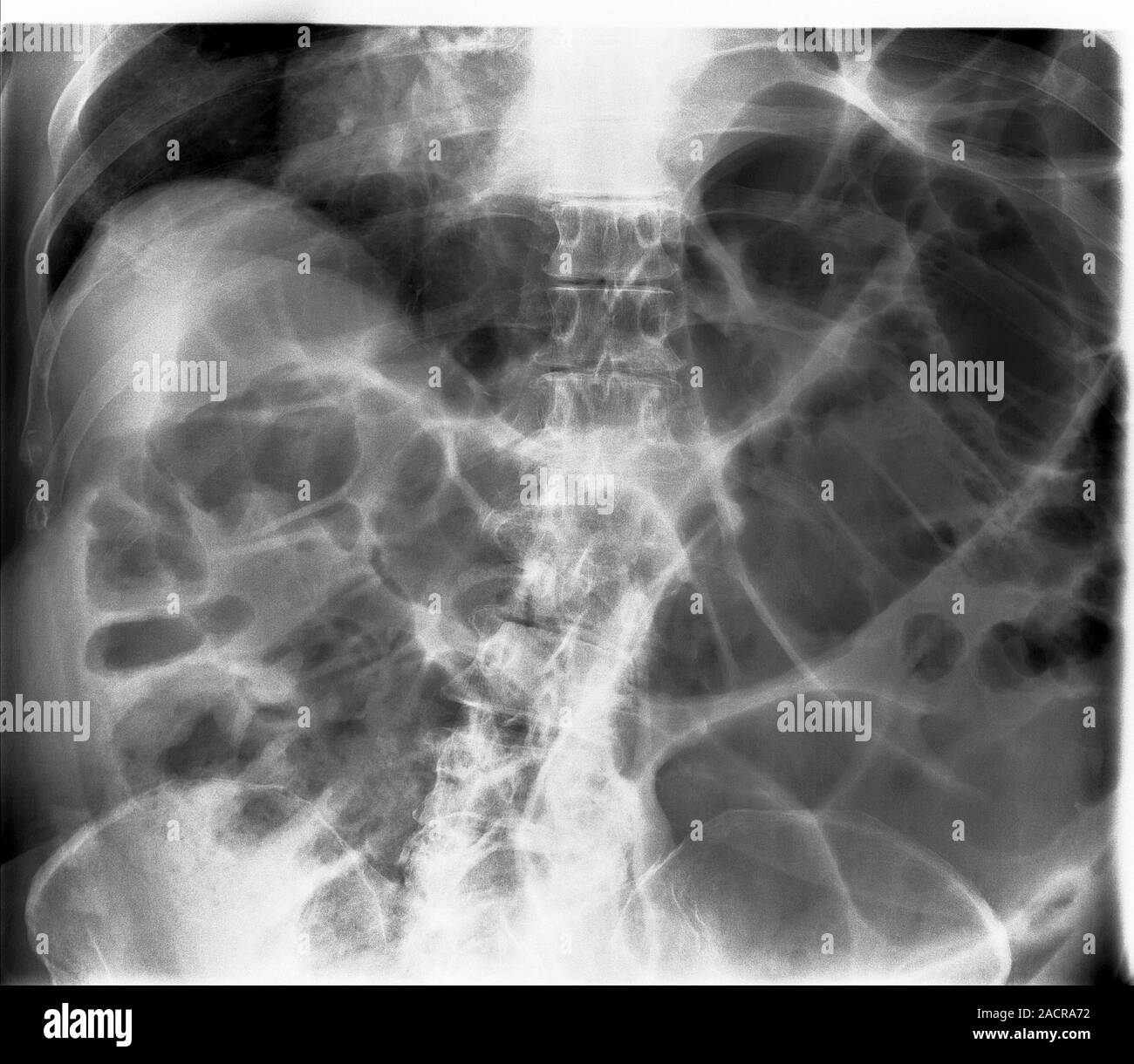 Large bowel obstruction. X-ray of the abdomen of a patient with an ...