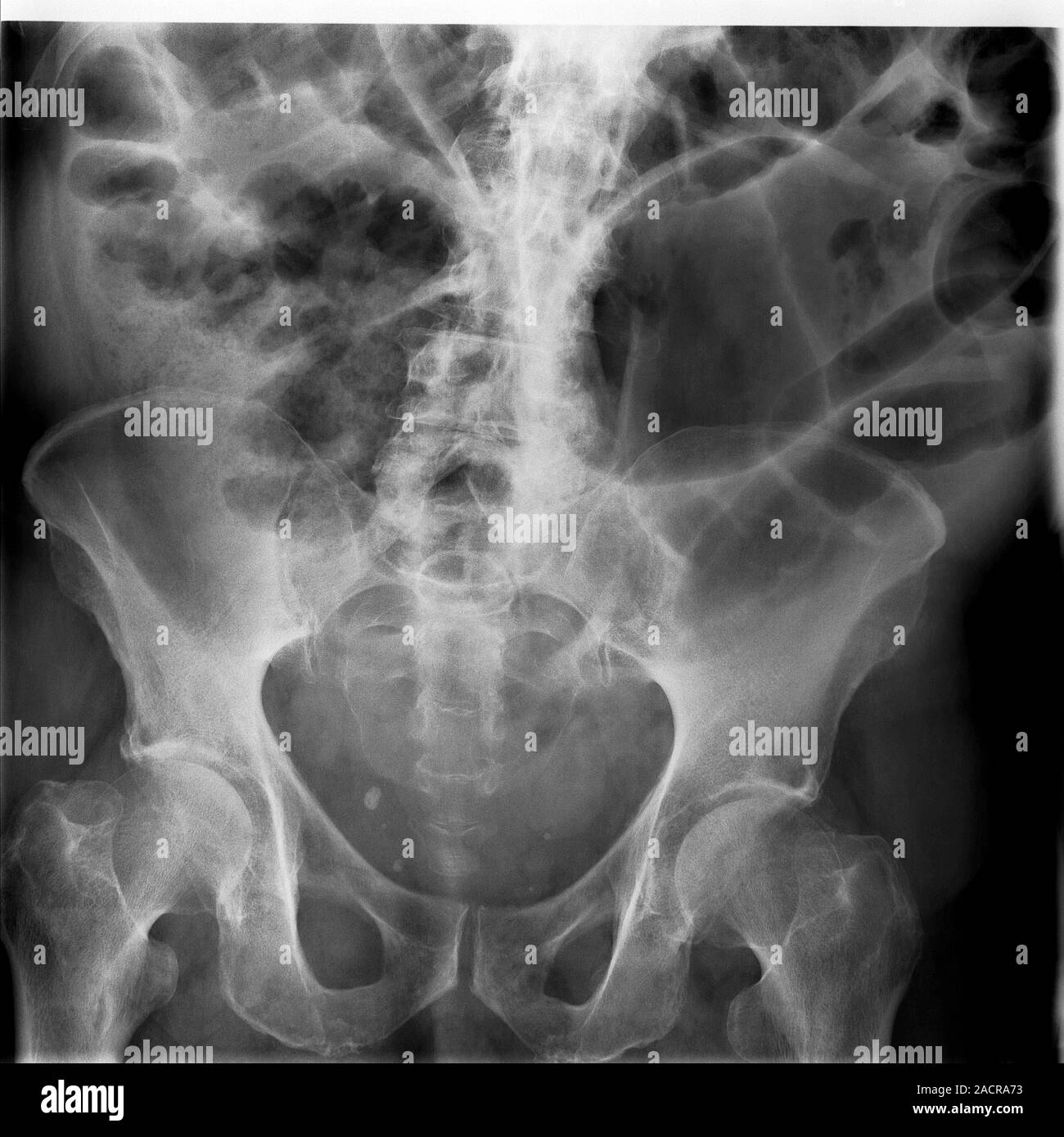 Large bowel obstruction. X-ray of the abdomen of a patient with an ...