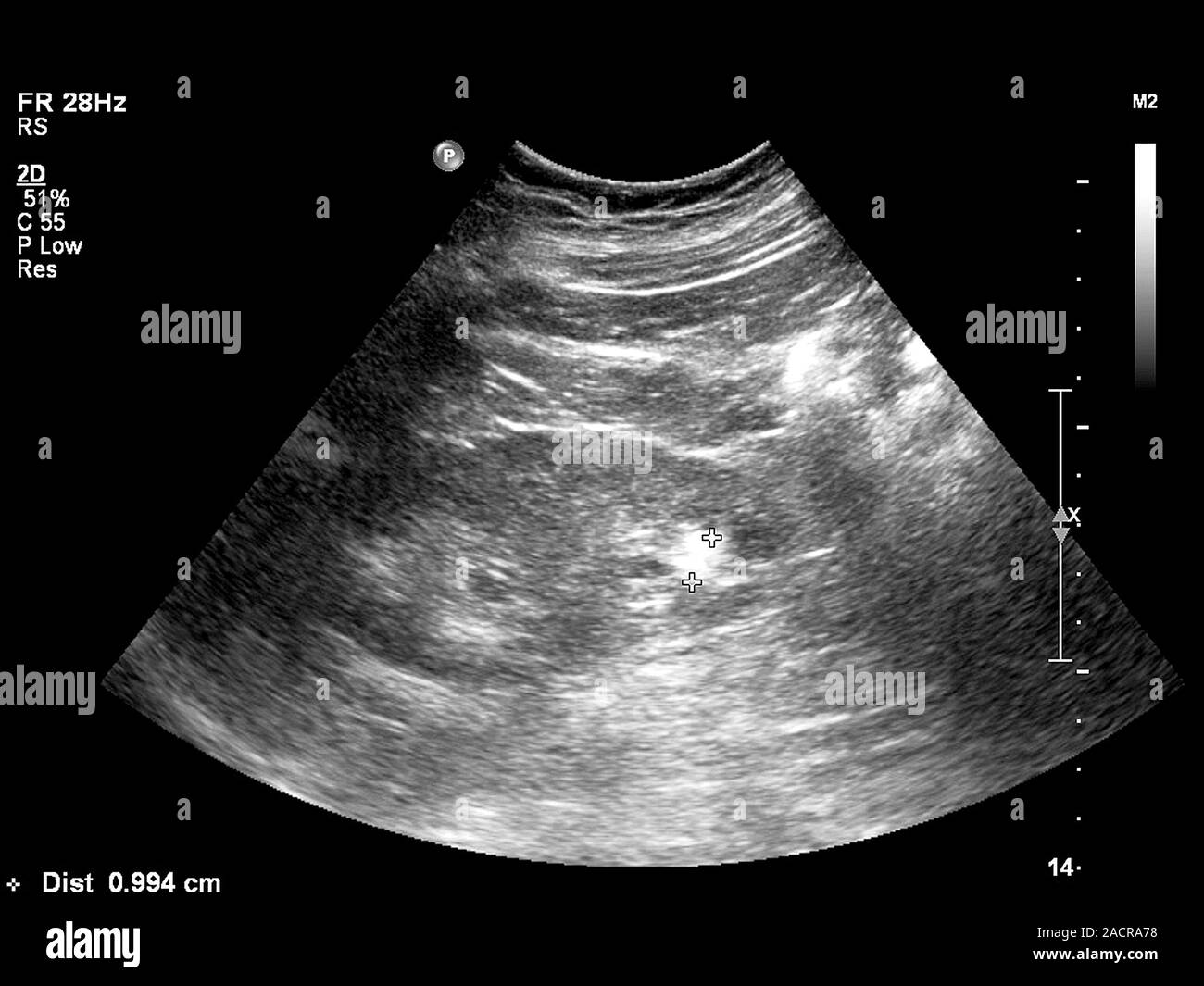 Gallstone. Ultrasound scan of the abdomen of a patient that has a ...