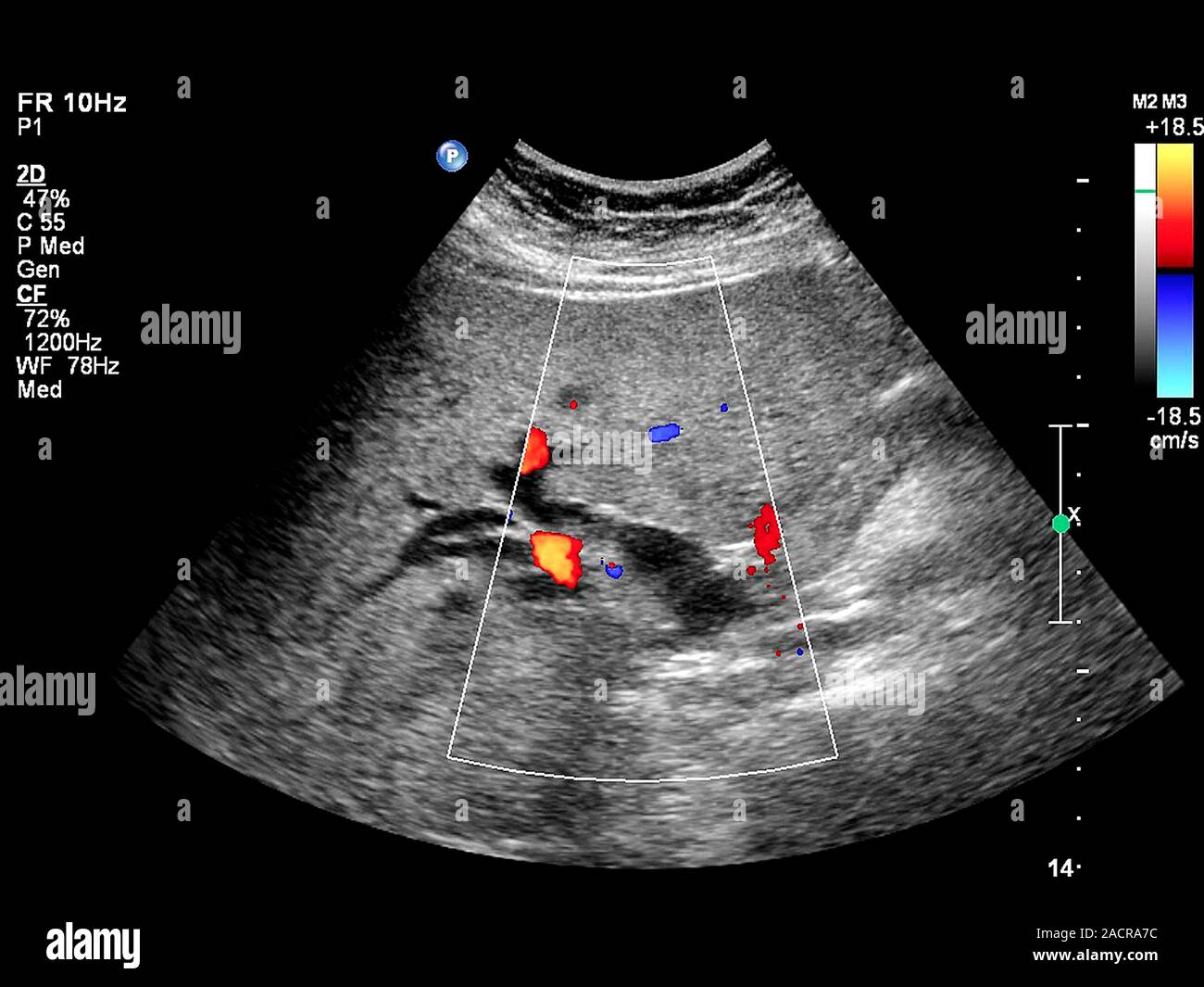 Gallstone. Doppler ultrasound scan of the abdomen of a patient that has ...