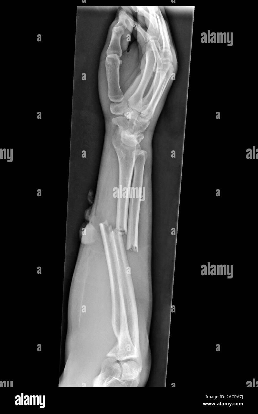 Broken arm. X-ray of the arm of a patient that has broken both of the ...