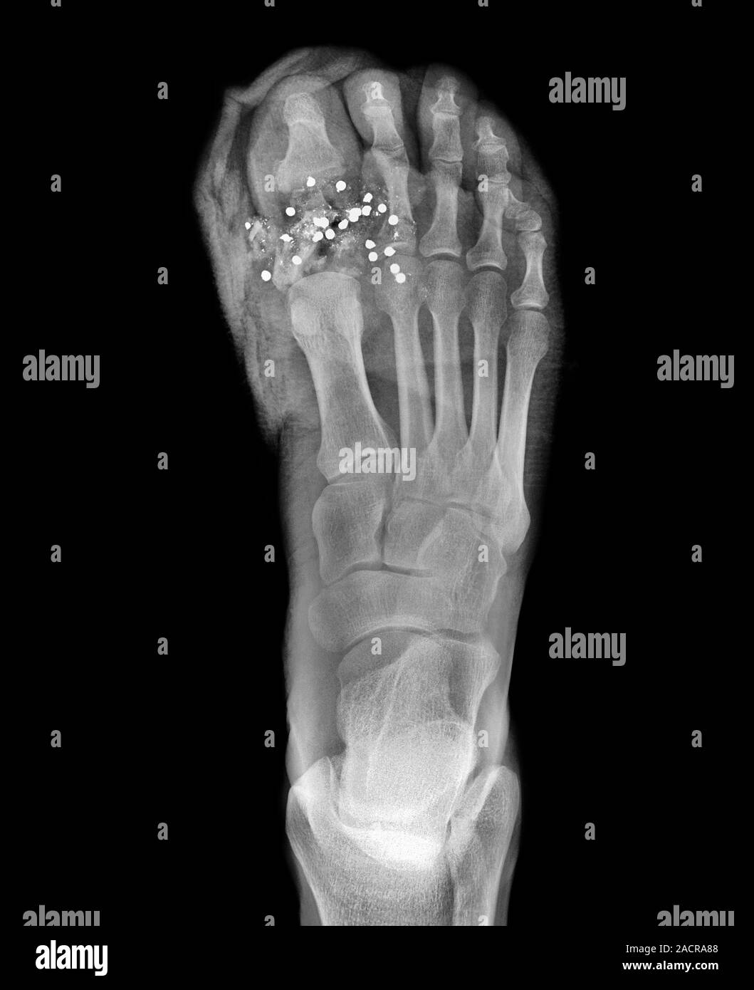 Firearm injury. X-ray of the foot of a patient who has been shot with a ...