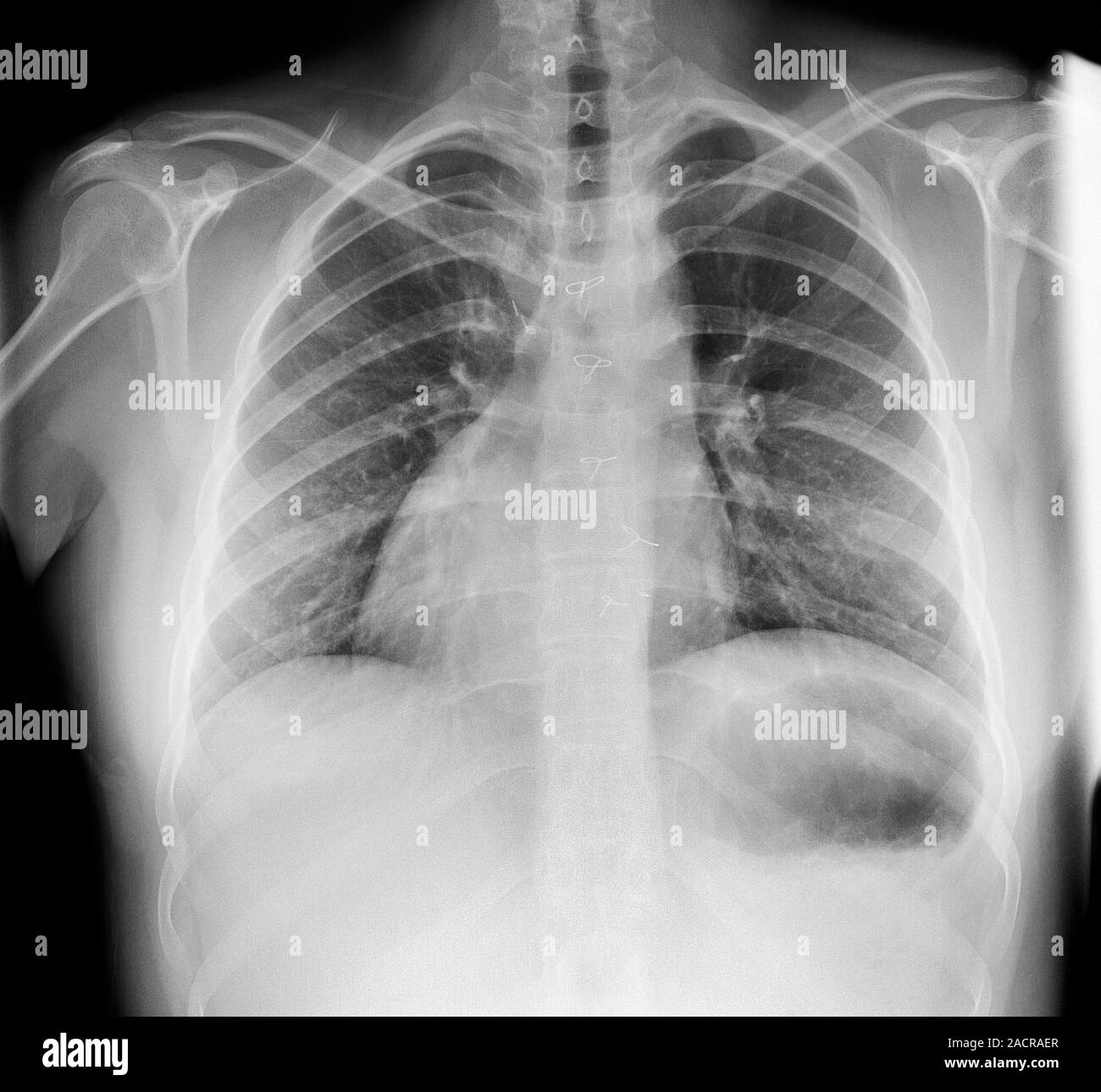 Reversed heart position. X-ray of the chest of a patient with ...