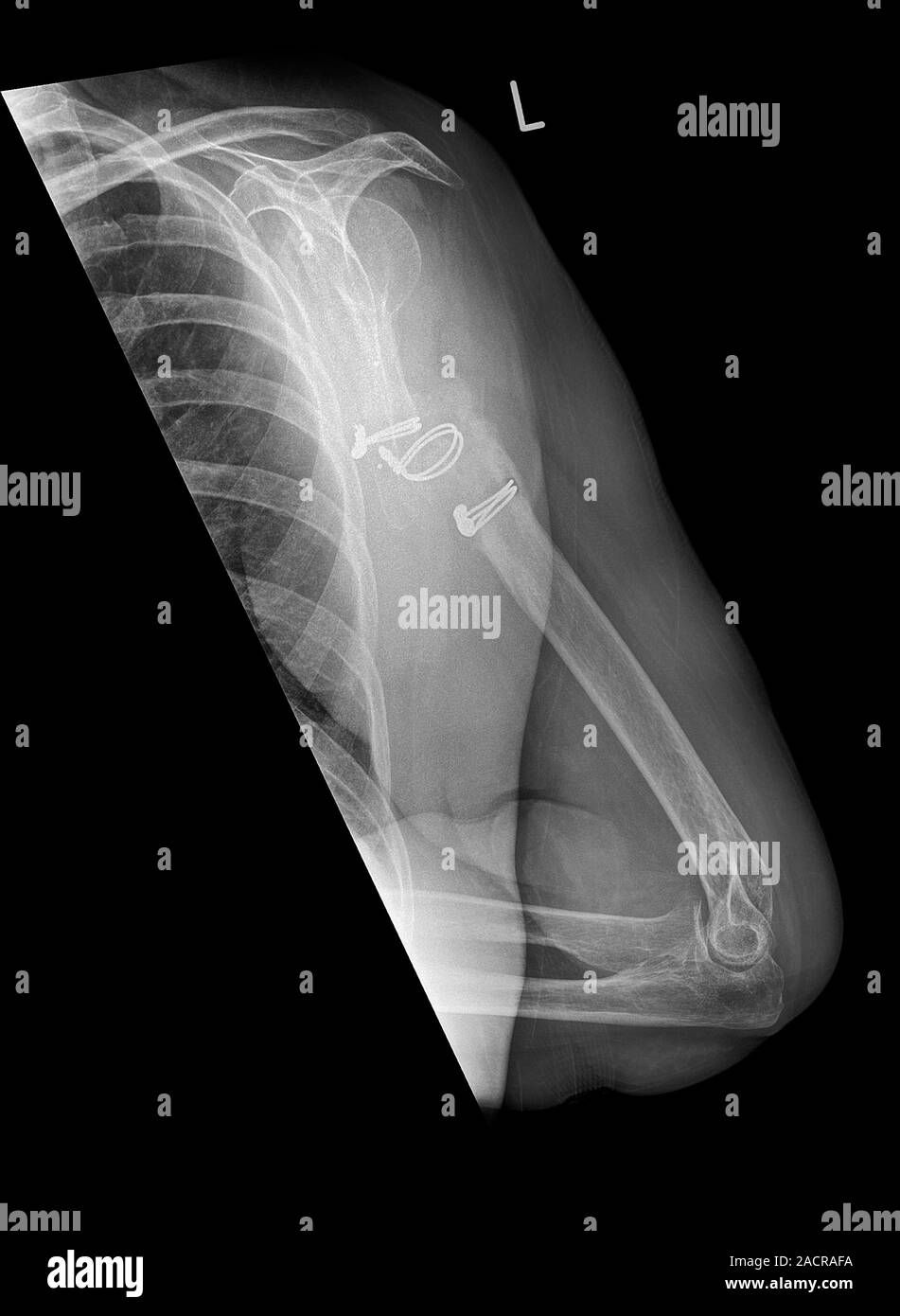Infected malunited fracture. X-ray of the arm of a 65 year old female ...