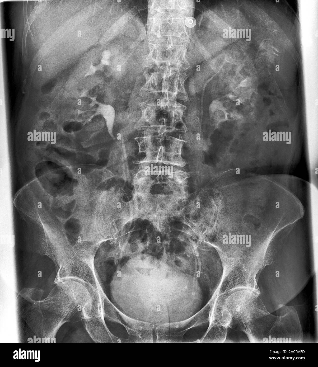 Duplex kidney collecting system. X-ray of the abdomen of a 78 year old ...