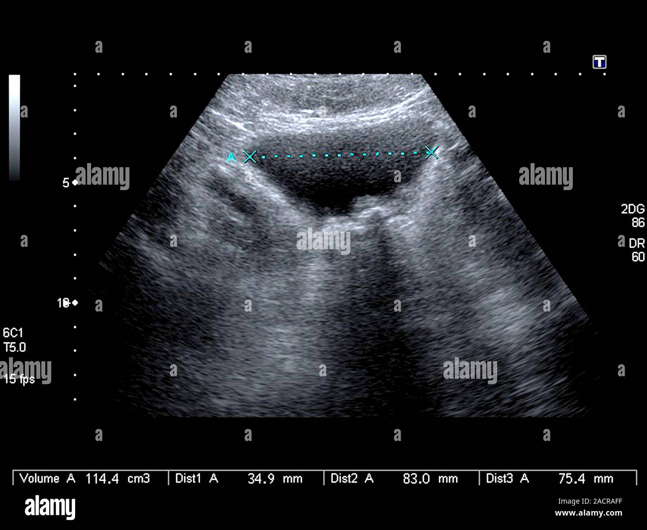 Bladder stones. Ultrasound scan of the bladder of a 58 year old male ...