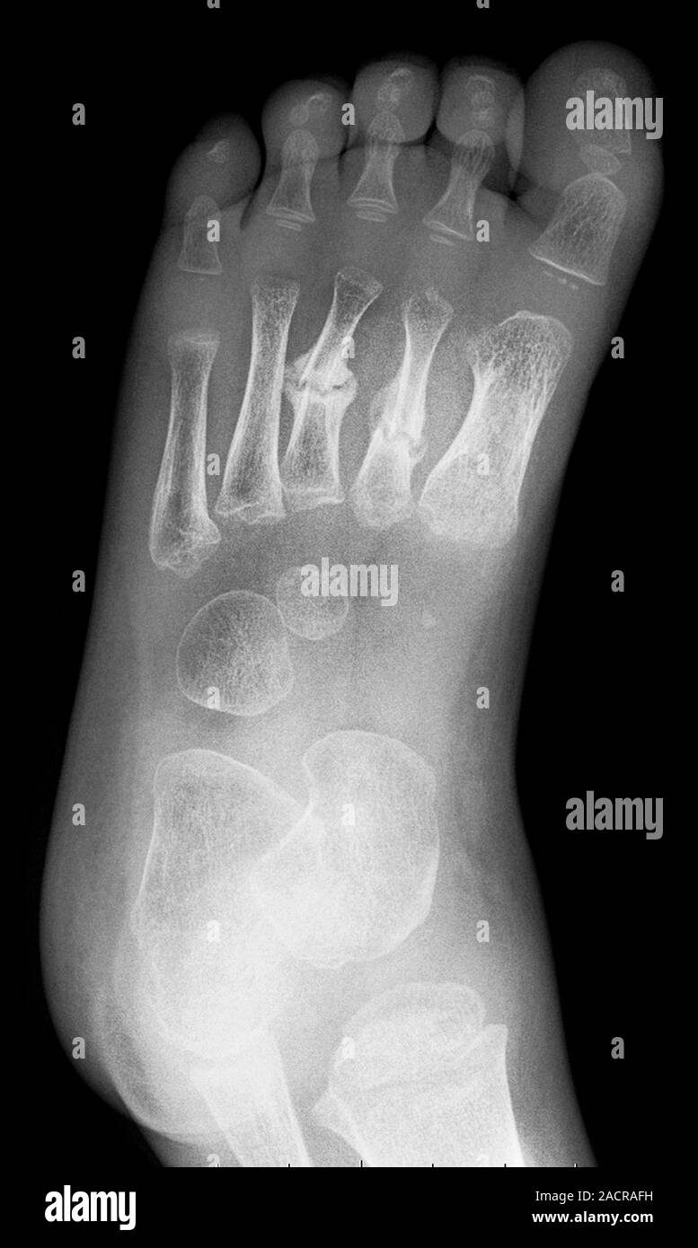Broken foot. X-ray of the foot of a 3 year old male patient with ...