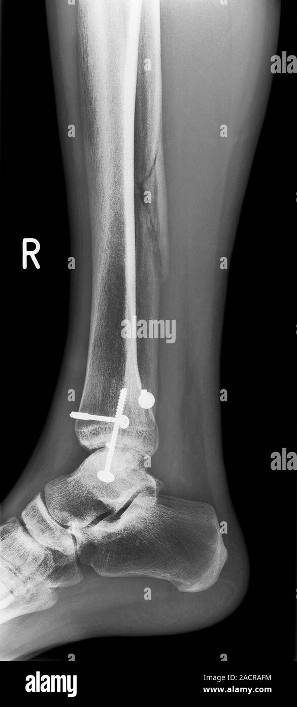 Pinned Broken Ankle X Ray Of The Ankle Of A 32 Year Old Male That Has Been Pinned After A