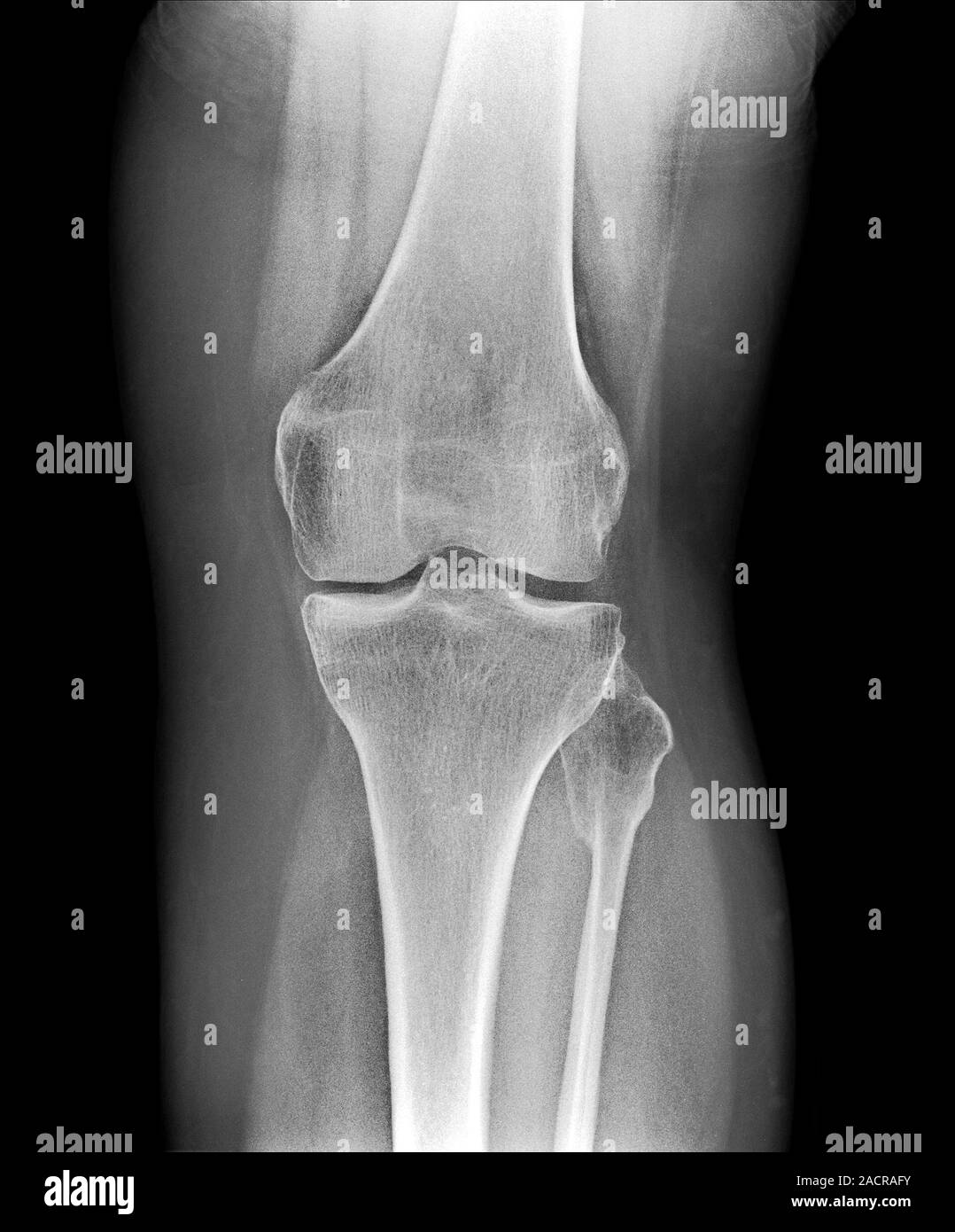Removed kneecap. X-ray of the knee of a 46 year old female that has had ...