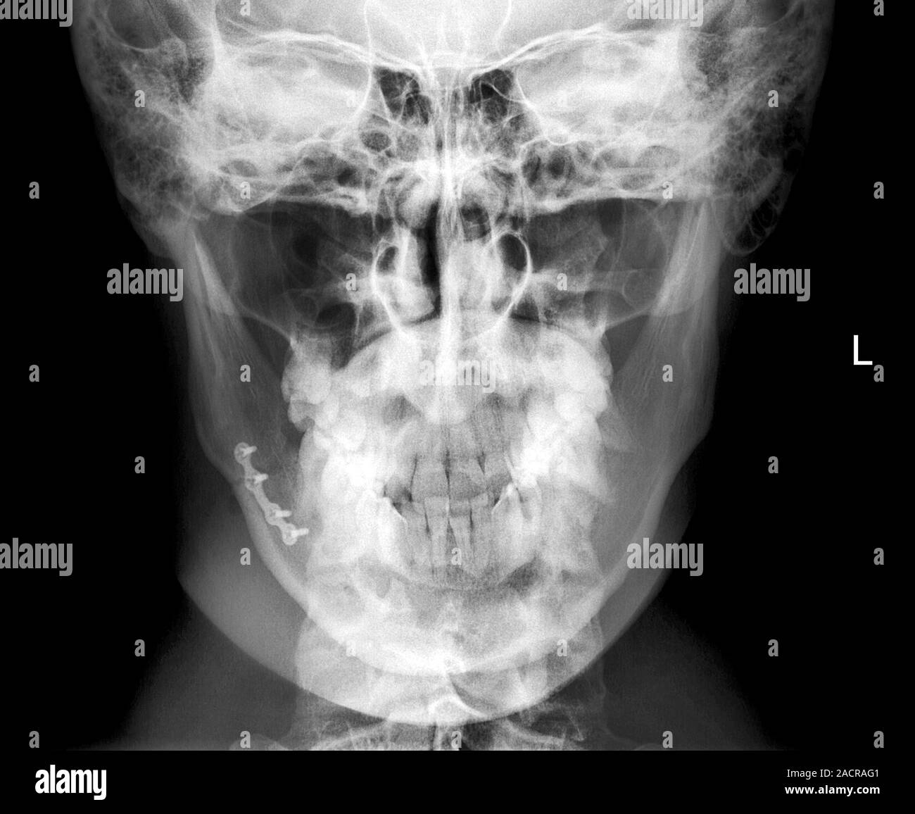 Pinned jaw fracture. X-ray of the head of a 22 year old male patient ...