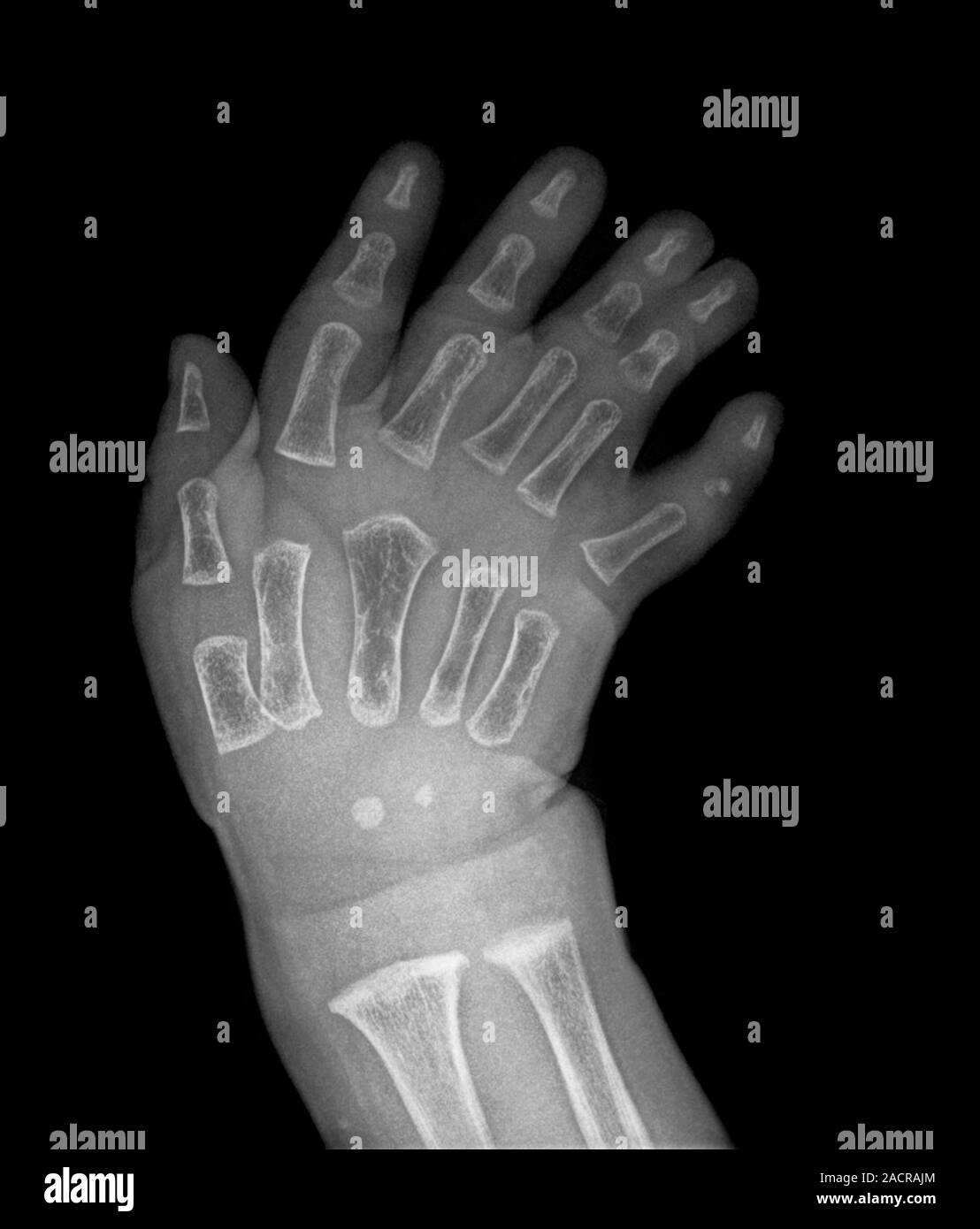 Extra fingers. X-ray of the hand of a one year old male patient with an ...