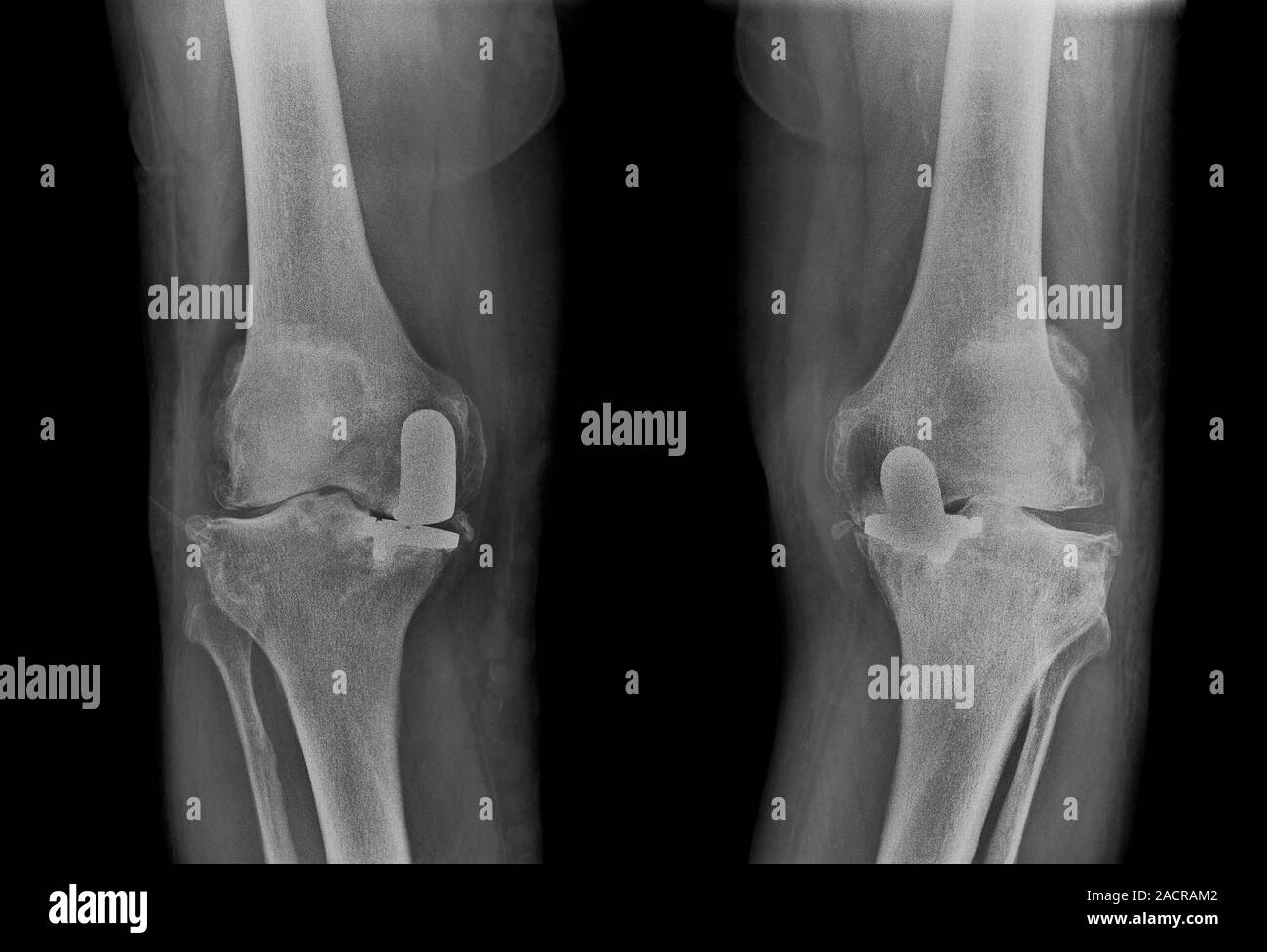 Arthritic knees. X-ray of the knees of a patient with osteoarthritis ...