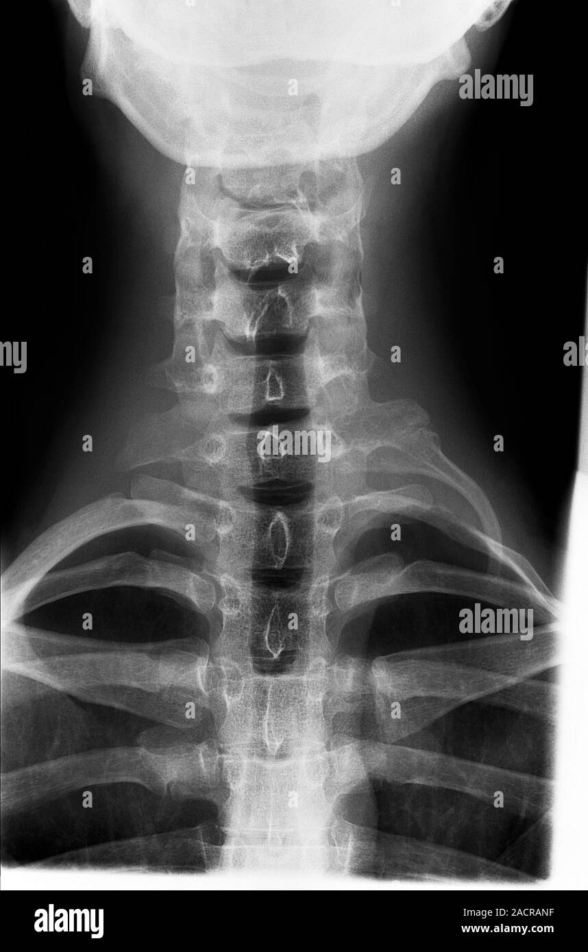 Cervical rib. X-ray of the neck of a patient with an extra rib on the ...
