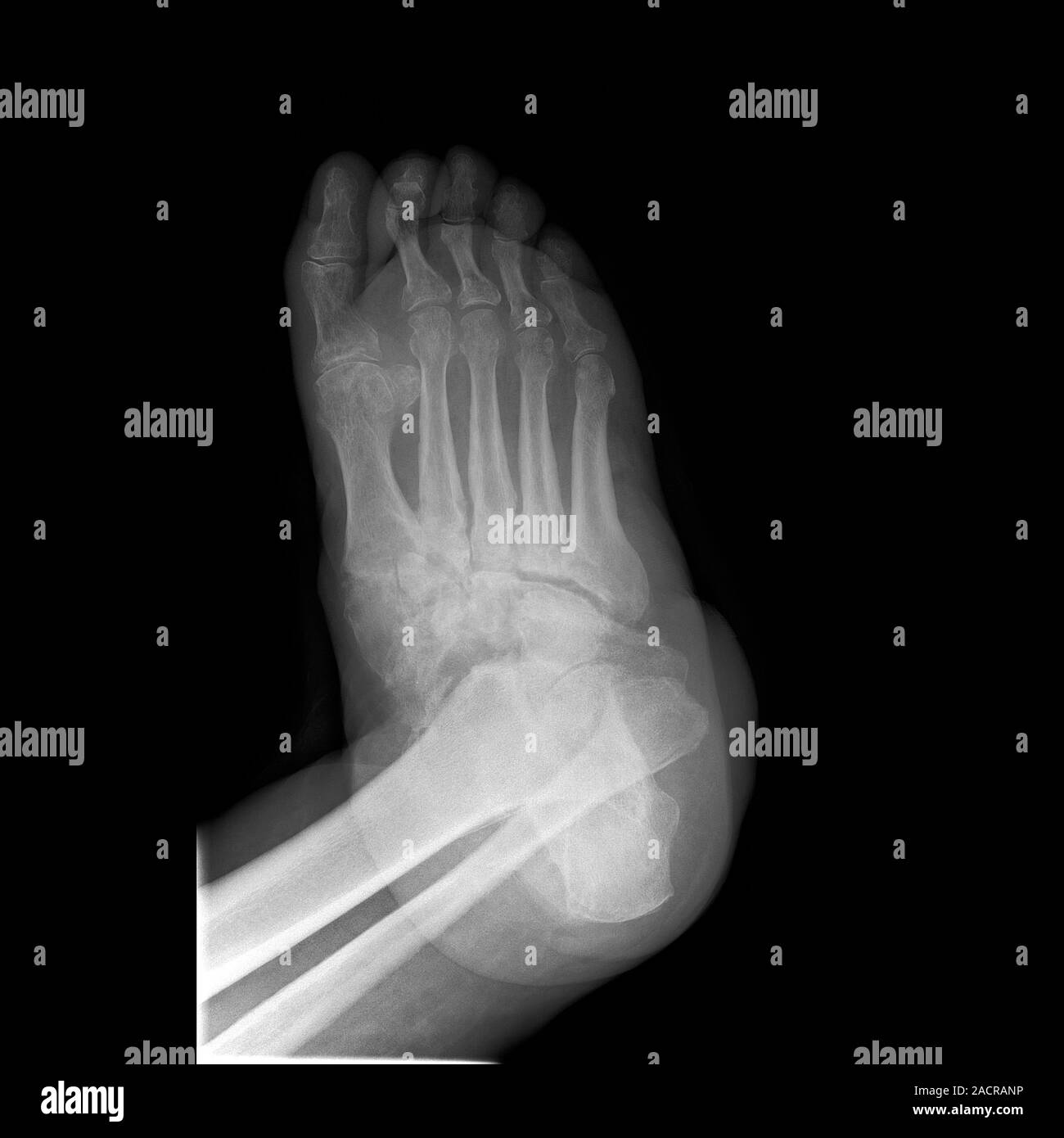 Salter Harris X Ray