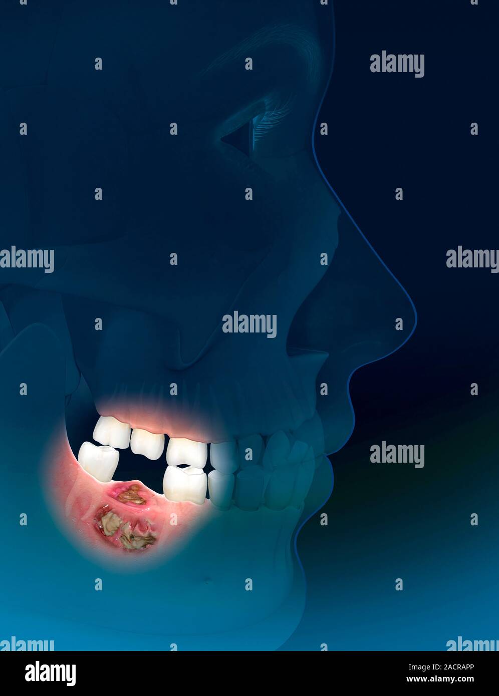 Osteonecrosis of the jaw. Computer artwork showing osteonecrosis (death ...