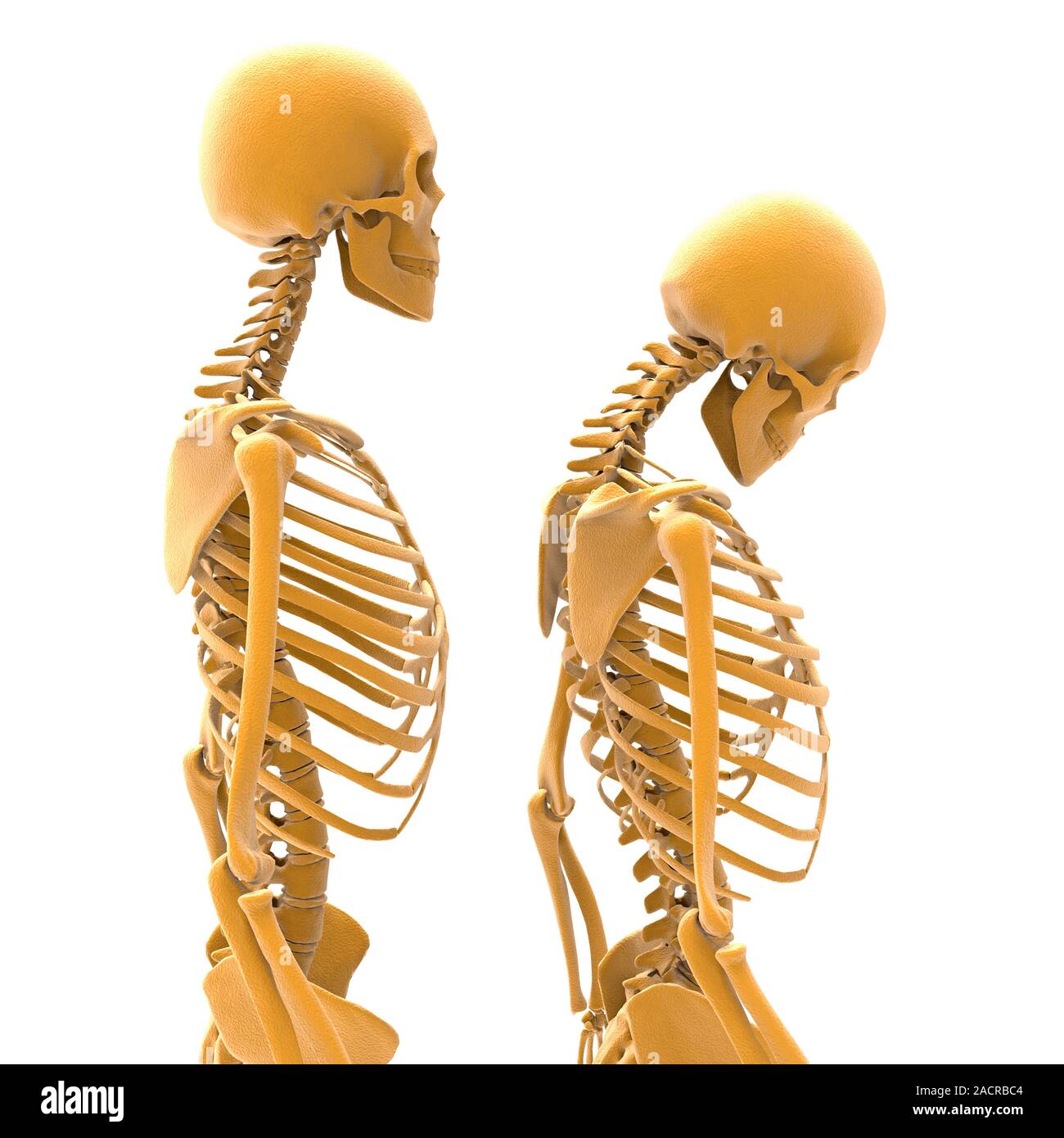 Osteoporosis. Computer artwork of a human female skeleton degenerating ...
