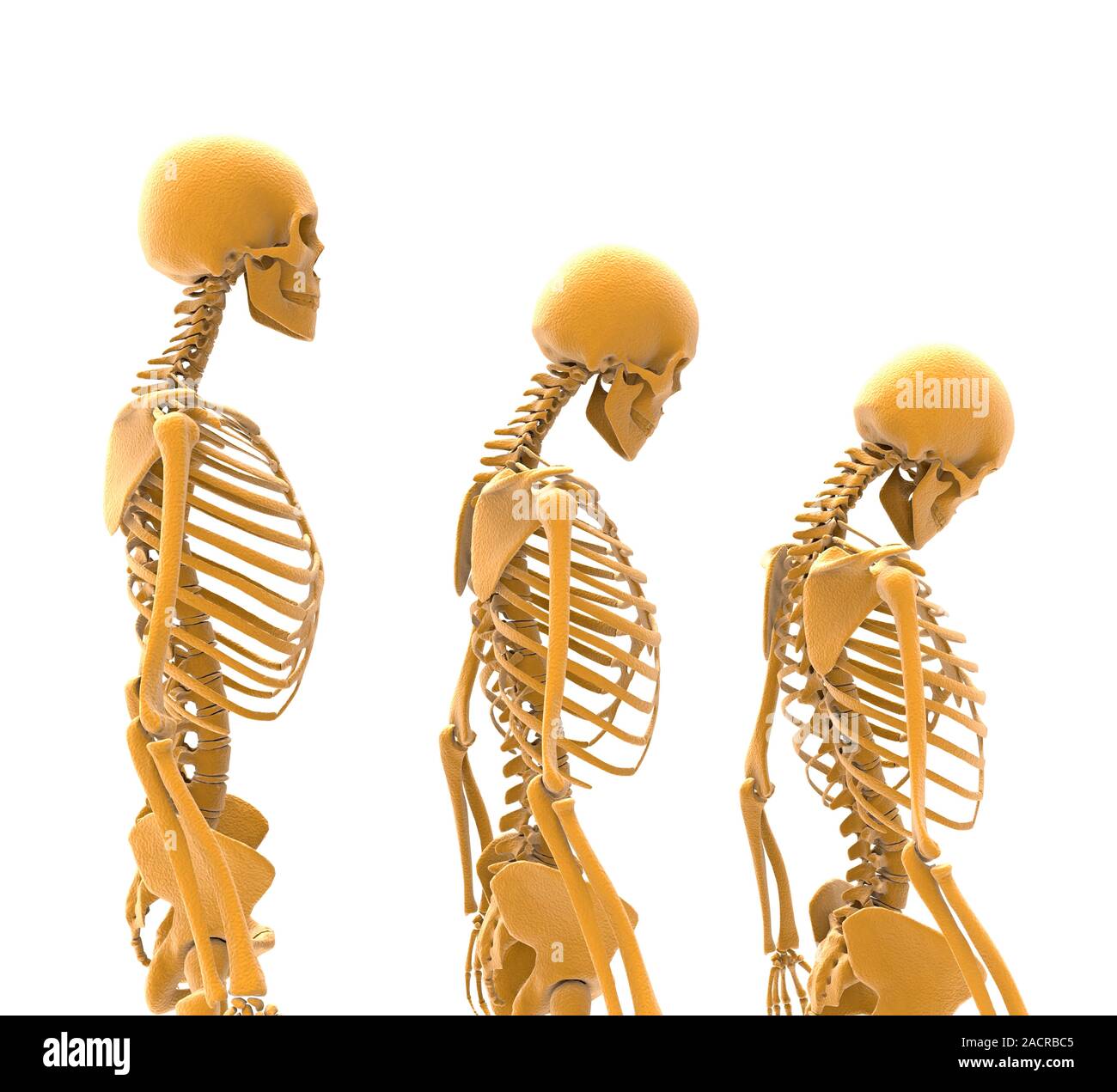 Osteoporosis. Computer artwork of a human female skeleton degenerating ...