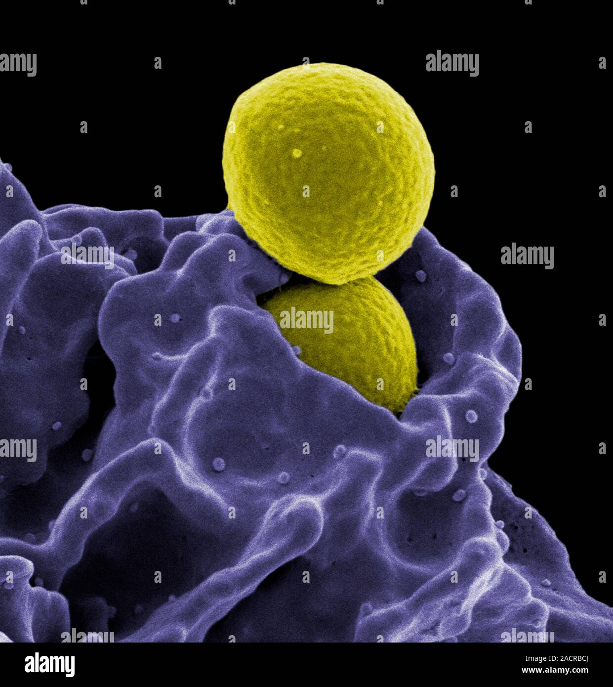 Neutrophil engulfing MRSA. Coloured scanning electron micrograph (SEM ...