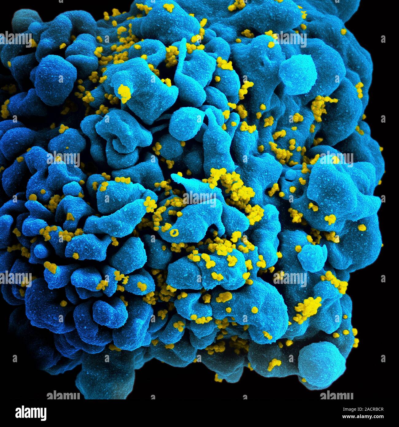 Budding HIV particles. Coloured scanning electron micrograph (SEM) of ...