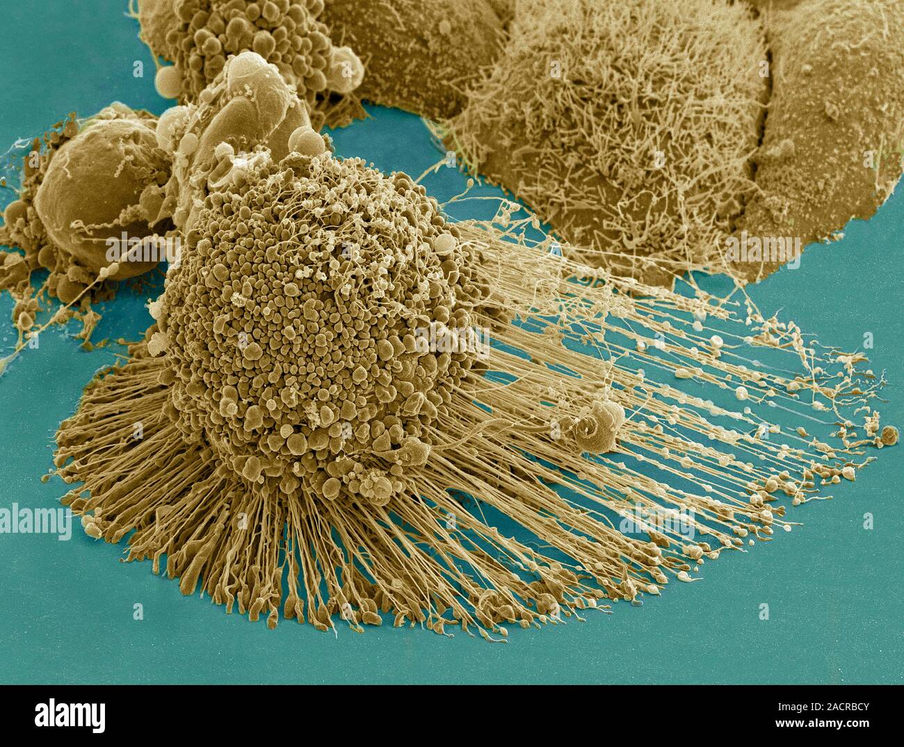 HeLa cell dying, coloured scanning electron micrograph (SEM). The cell ...