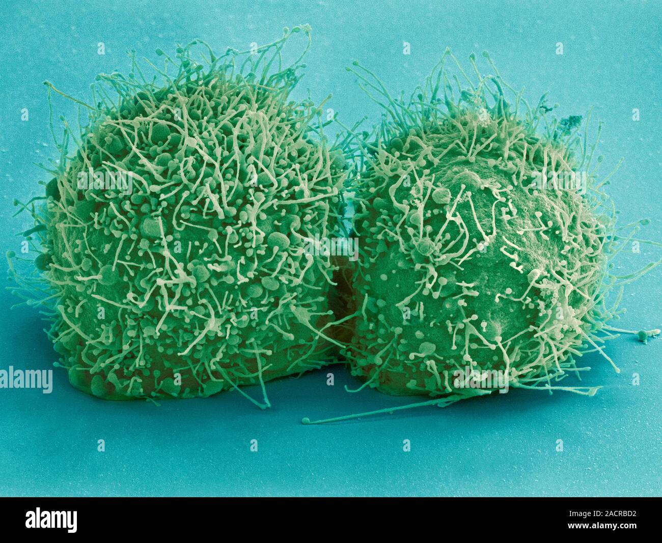 HeLa cells, coloured scanning electron micrograph (SEM). The cells have ...