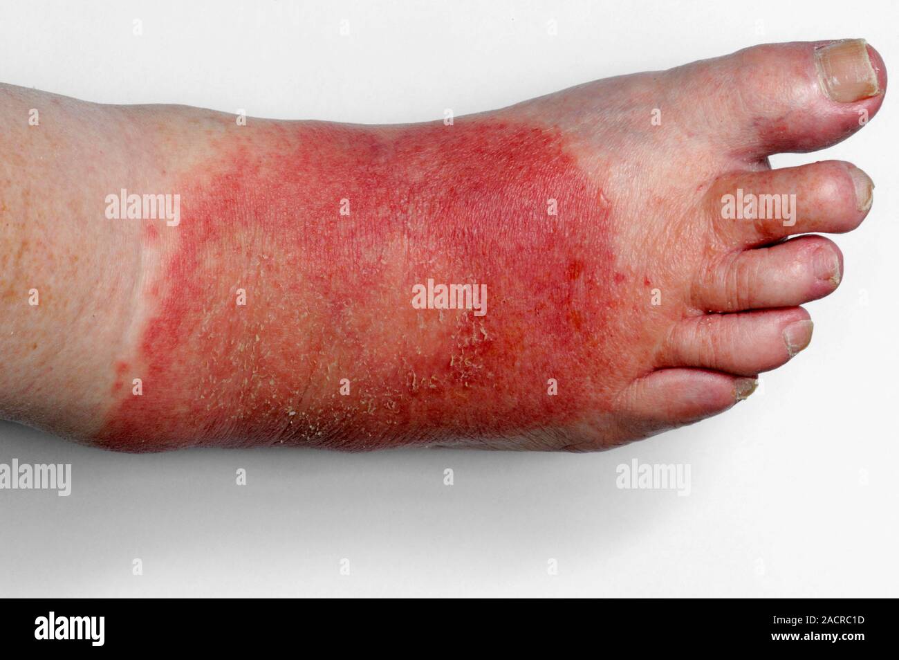 Not for use in Television Not for use in Television Rash due to drug ...