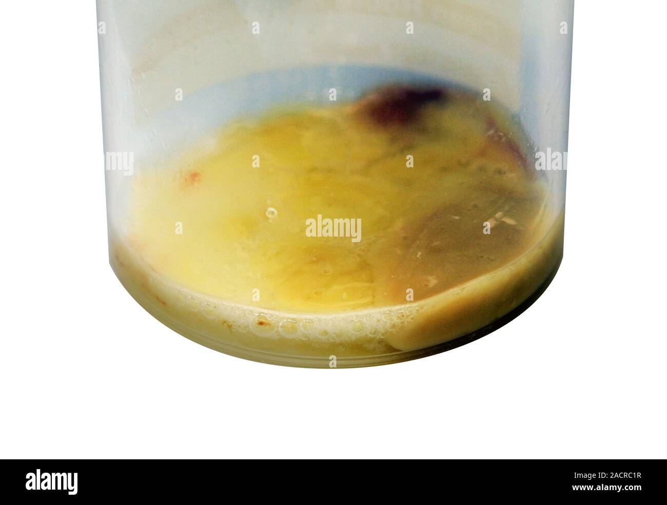 Not for use in Television Infected sputum sample. Sputum is mucous ...