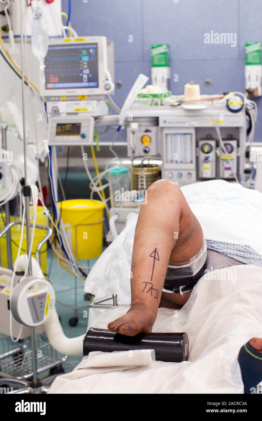 Knee surgery. Patient's leg labelled prior to total knee replacement ...