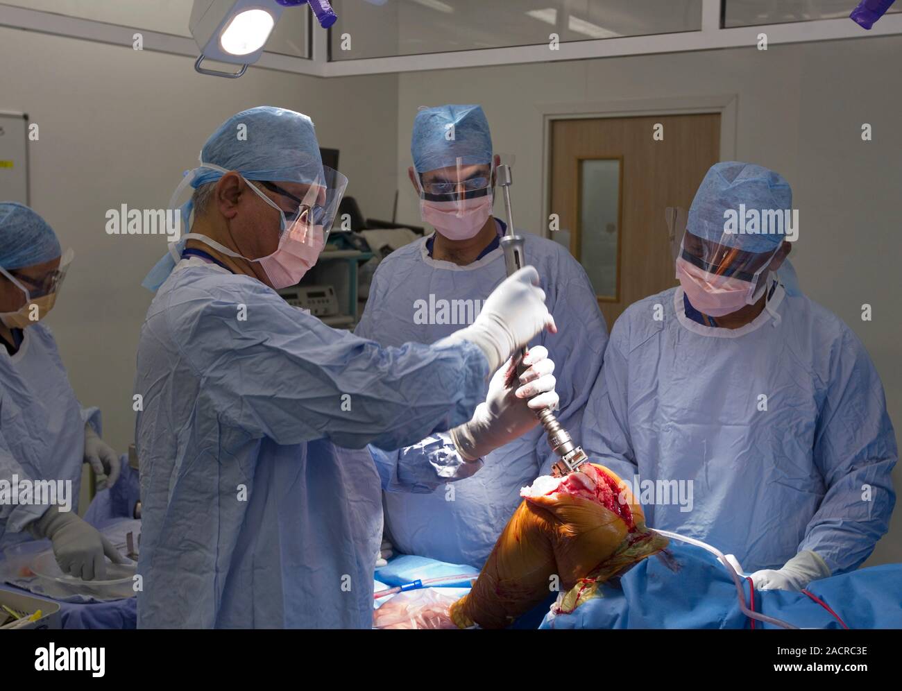 Knee replacement surgery. Surgical team performing a total knee ...