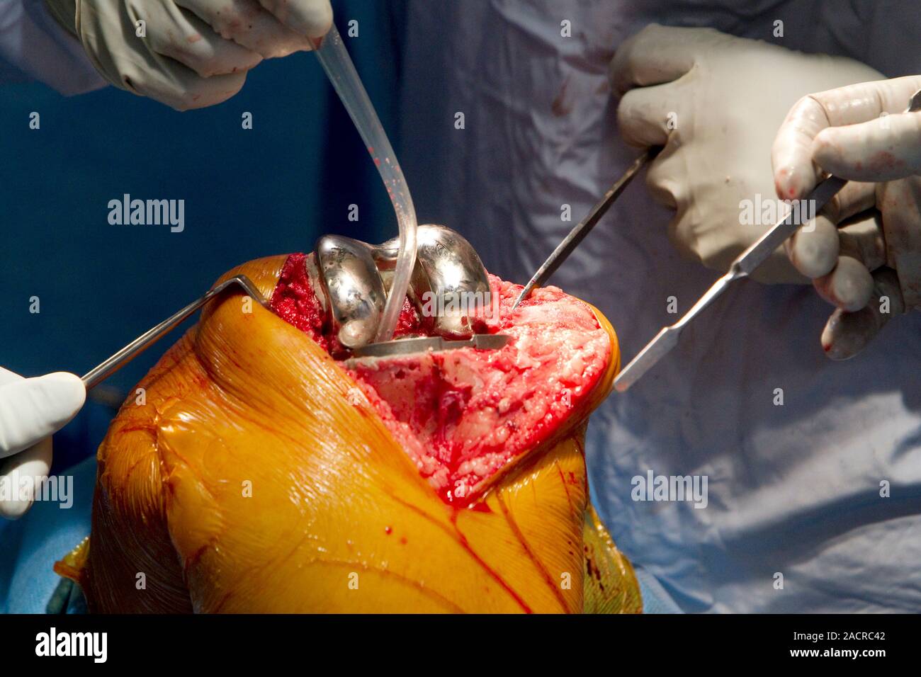 Knee replacement surgery. Surgical team performing a total knee ...