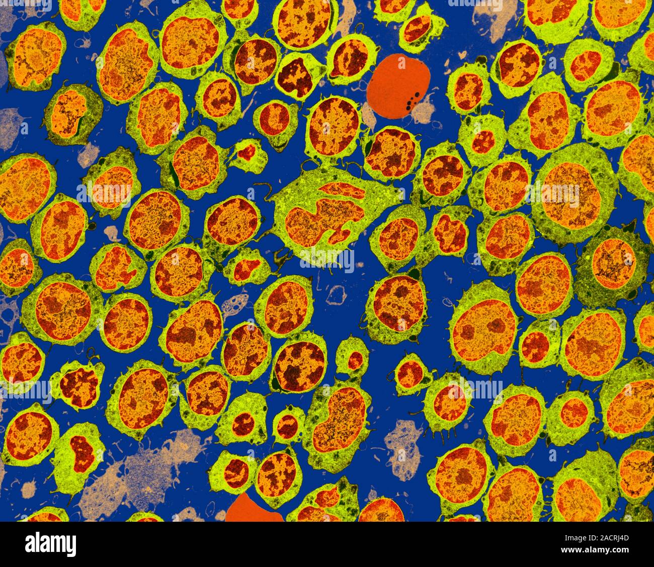 Leukaemia. Coloured transmission electron micrograph (TEM) of a blood ...