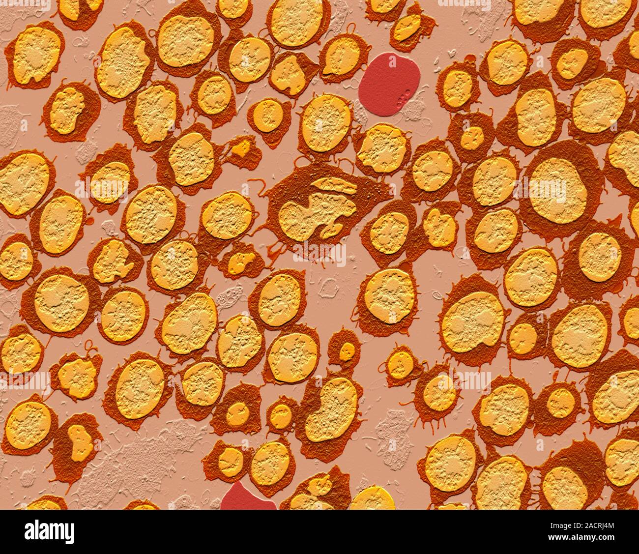 Leukaemia. Coloured transmission electron micrograph (TEM) of a blood ...