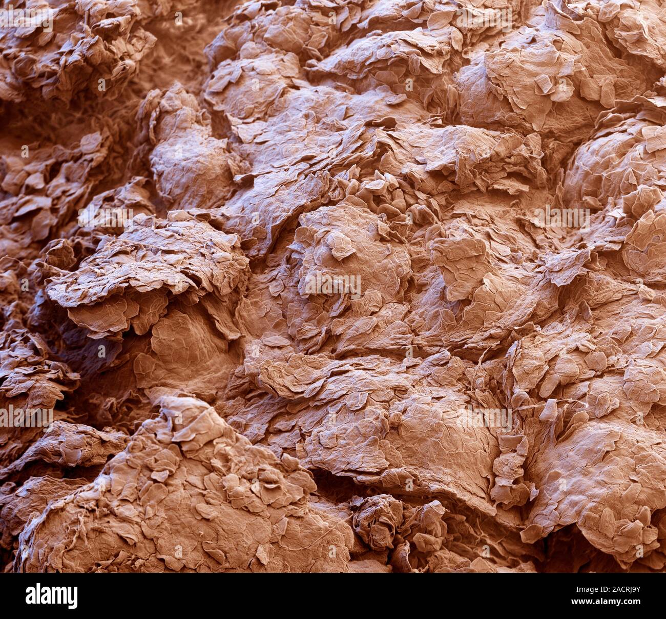 Psoriasis. Coloured scanning electron micrograph (SEM) of skin cells ...